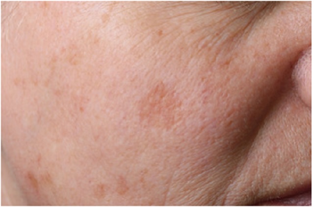 Cómo eliminar pecas - 14 pasos - Belleza Doncomos.com