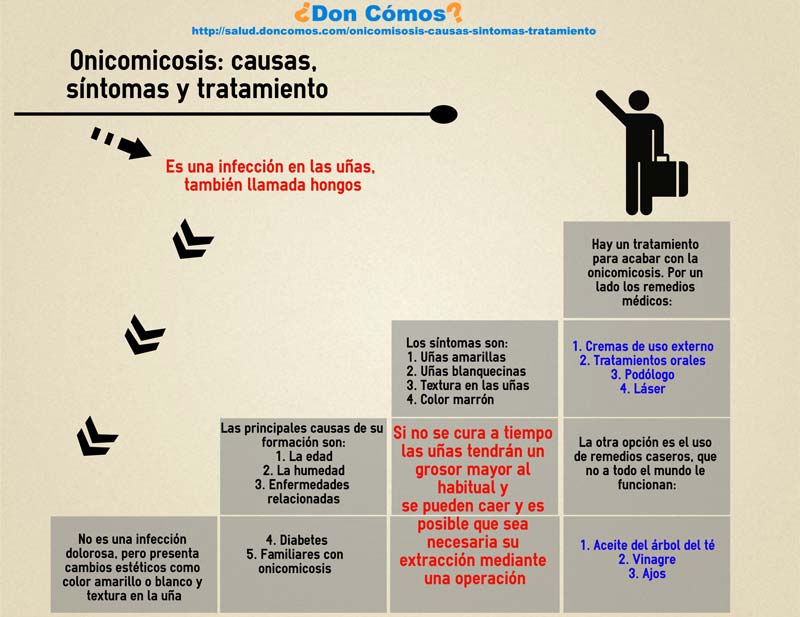 Onicomicosis: causas, síntomas y tratamiento - Salud Doncomos.com