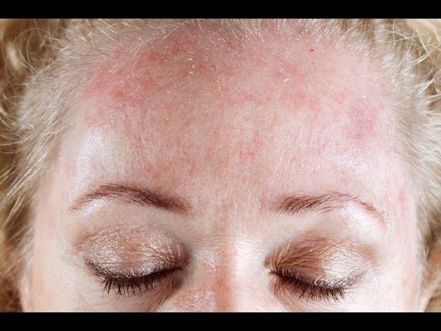 Cómo curar la dermatitis - 5 pasos - Salud Doncomos.com
