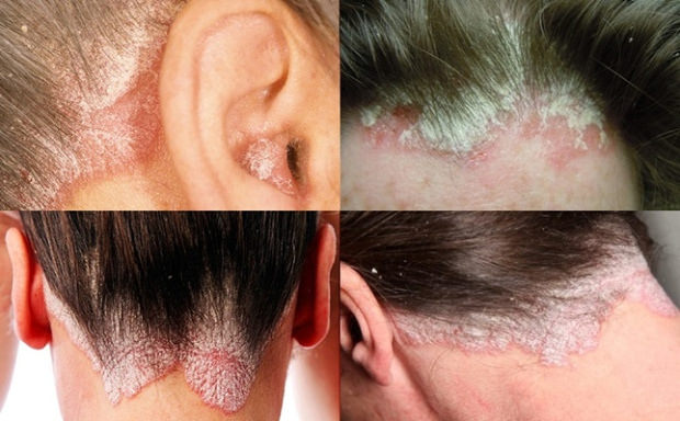 Psoriasis – Diferentes tipos de Psoriasis - Salud Doncomos.com